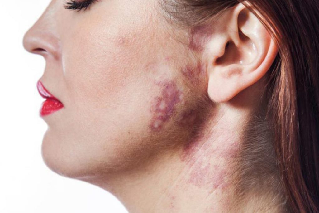 Birthmark - Este Medical Bangladesh Ltd : UK's Leading Skin, Body and ...